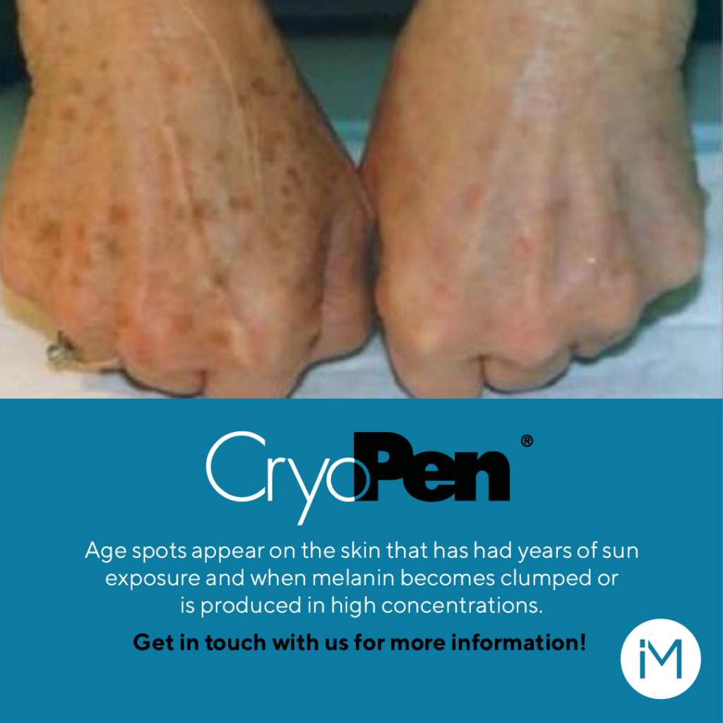 Cryopen Treatment- Secrets Medical Centre